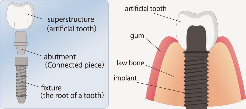One implant-Single stage without bone grafting and membrane – ADHPL