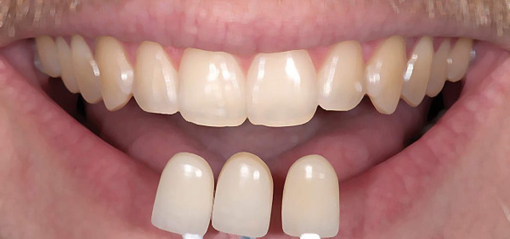 Anterior Tooth Coloured Restorations – Direct Five Surface Restoration ...